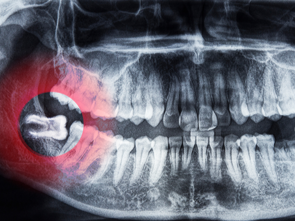 Wisdom Teeth | East Indy Dental Care | Indianapolis IN