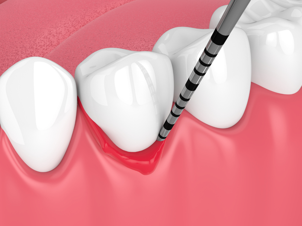Indianapolis Periodontist Service by East Indy Dental Care